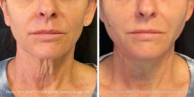 PDO Thread Lift – Nonsurgical Facelift NYC | StudioMD